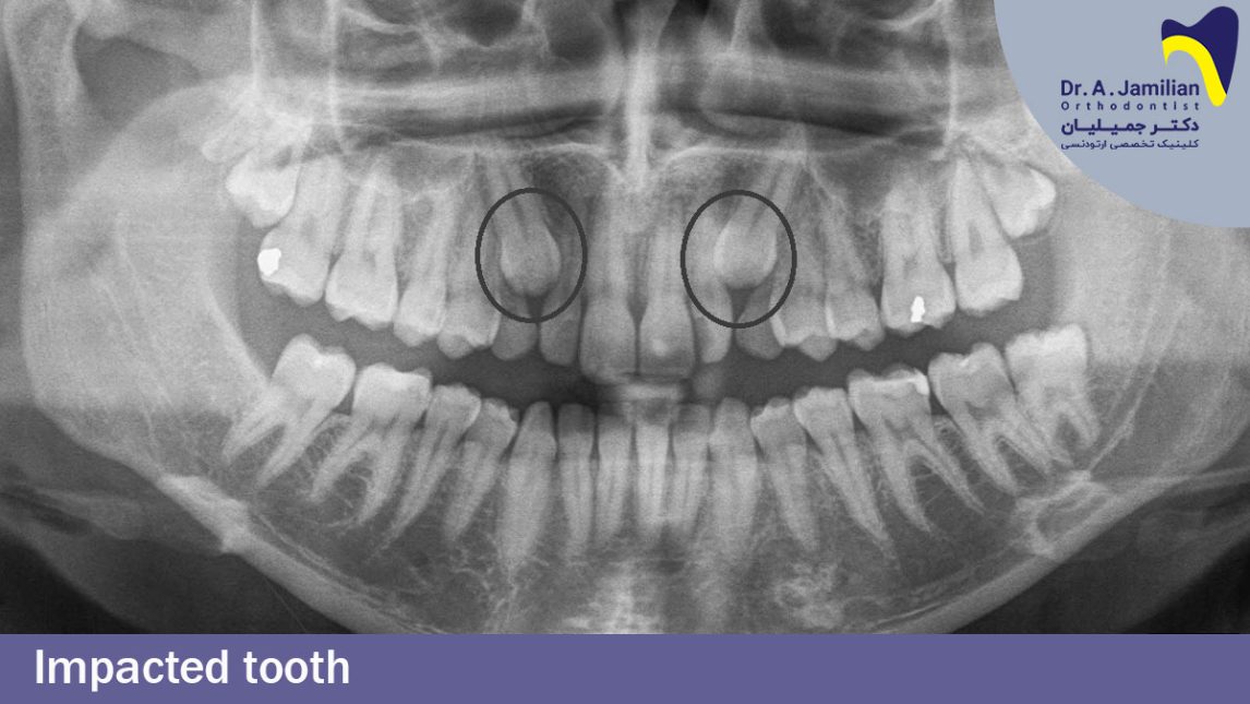 Impacted tooth - Dr Jamilian