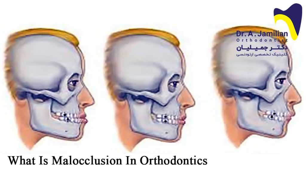 What is malocclusion in orthodontics? - Dr Jamilian