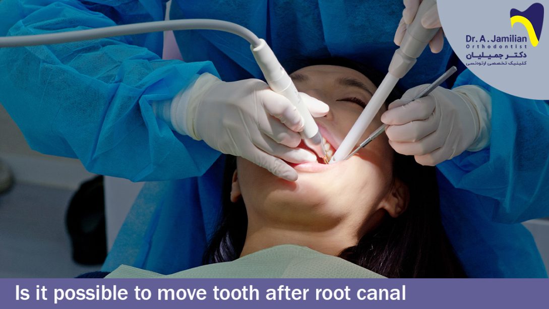Is it possible to move tooth after root canal - Dr Jamilian Is it possible to move tooth after root canal - Dr Jamilian