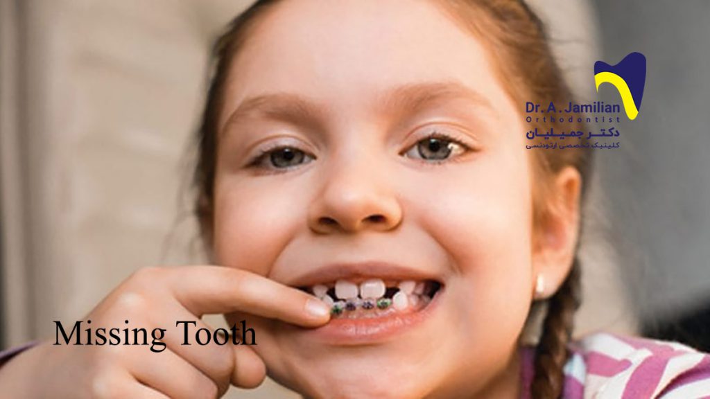 Missing Tooth - Dr Jamilian