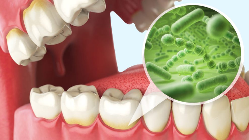 Everything about Gum Infection - Dr Jamilian
