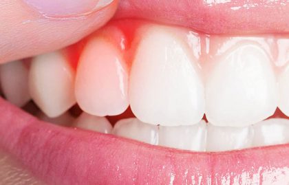 Everything about Gum Infection - Dr Jamilian