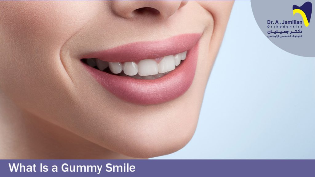 What Is a Gummy Smile? - Dr jamilian