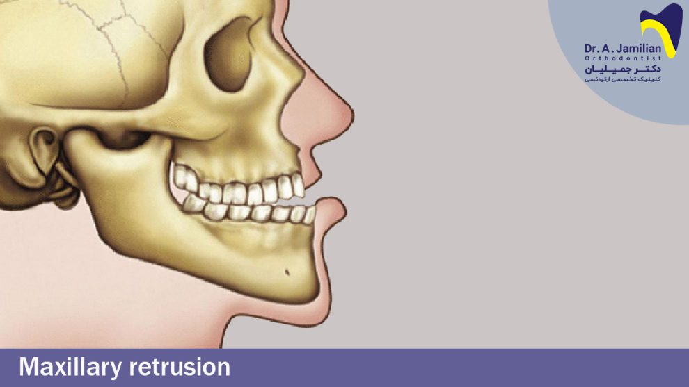 Maxillary Retrusion - Dr jamilian