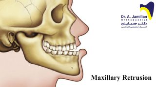 Maxillary Retrusion - Dr jamilian