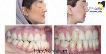 Maxillary Retrusion - Dr jamilian
