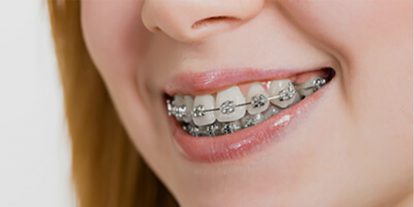 Treatment of rabbit teeth with orthodontics - Dr Jamilian