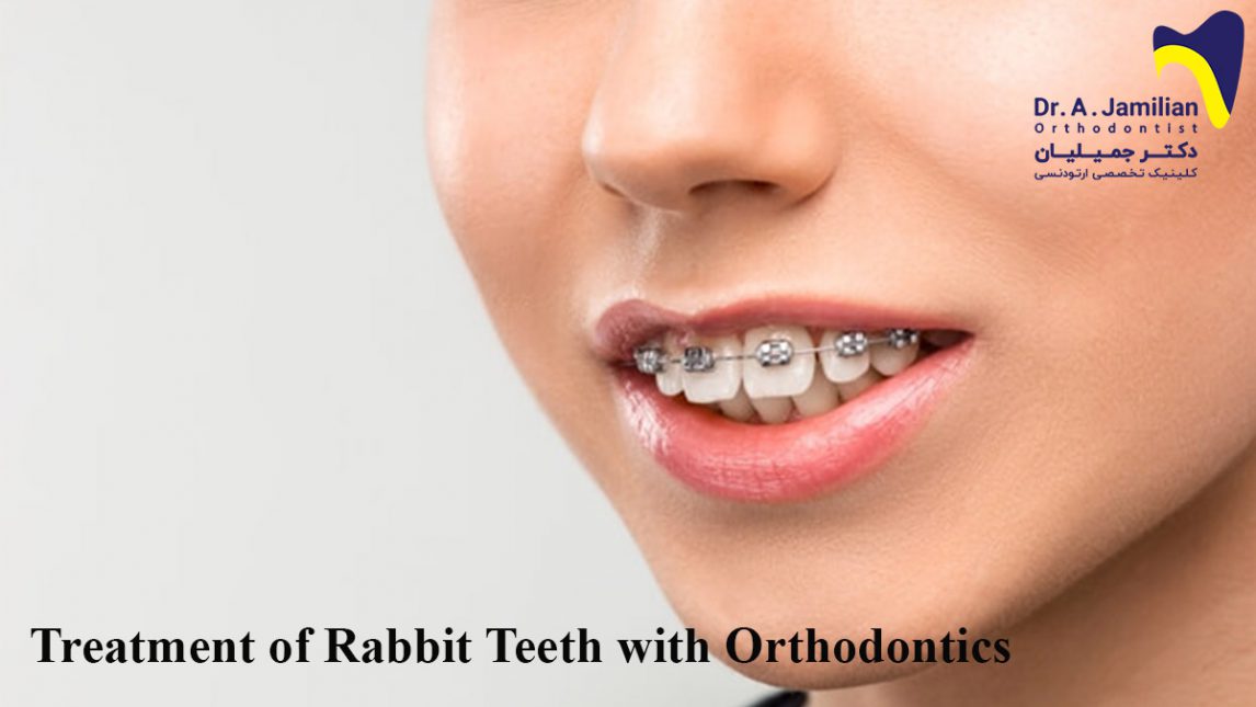 Treatment of rabbit teeth with orthodontics - Dr Jamilian