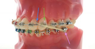 How to use orthodontic elastics - Dr Jamilian