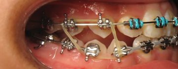 How to use orthodontic elastics - Dr Jamilian
