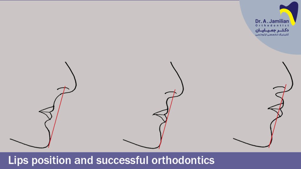 Lips position and successful orthodontics - Dr Jamilian