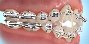 How to use orthodontic elastics - Dr Jamilian