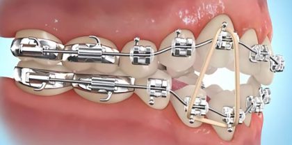 How to use orthodontic elastics - Dr Jamilian