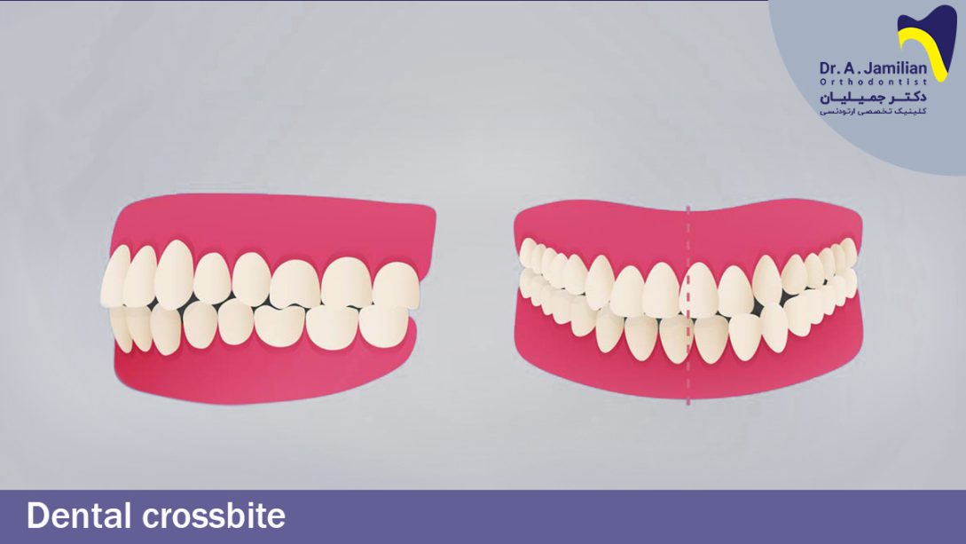 What is Dental Crossbite? - Dr Jamilian