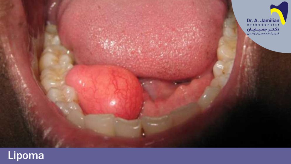 Lipomas of the Oral Cavity - Dr jamilian