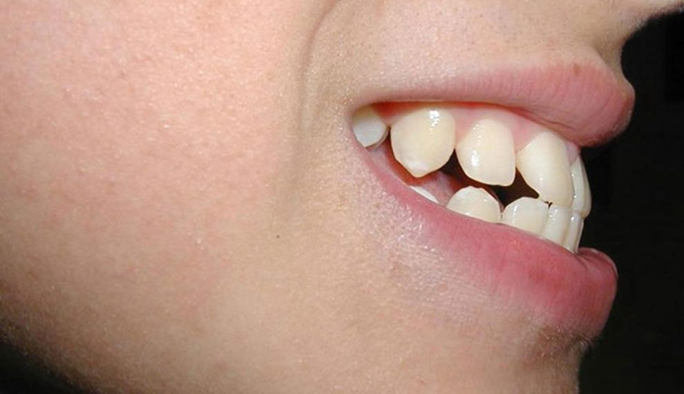 Orthodontic treatment for two front teeth - Dr Jamilian