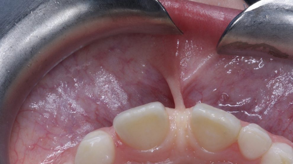 What is frenum and frenectomy? - Dr Jamilian