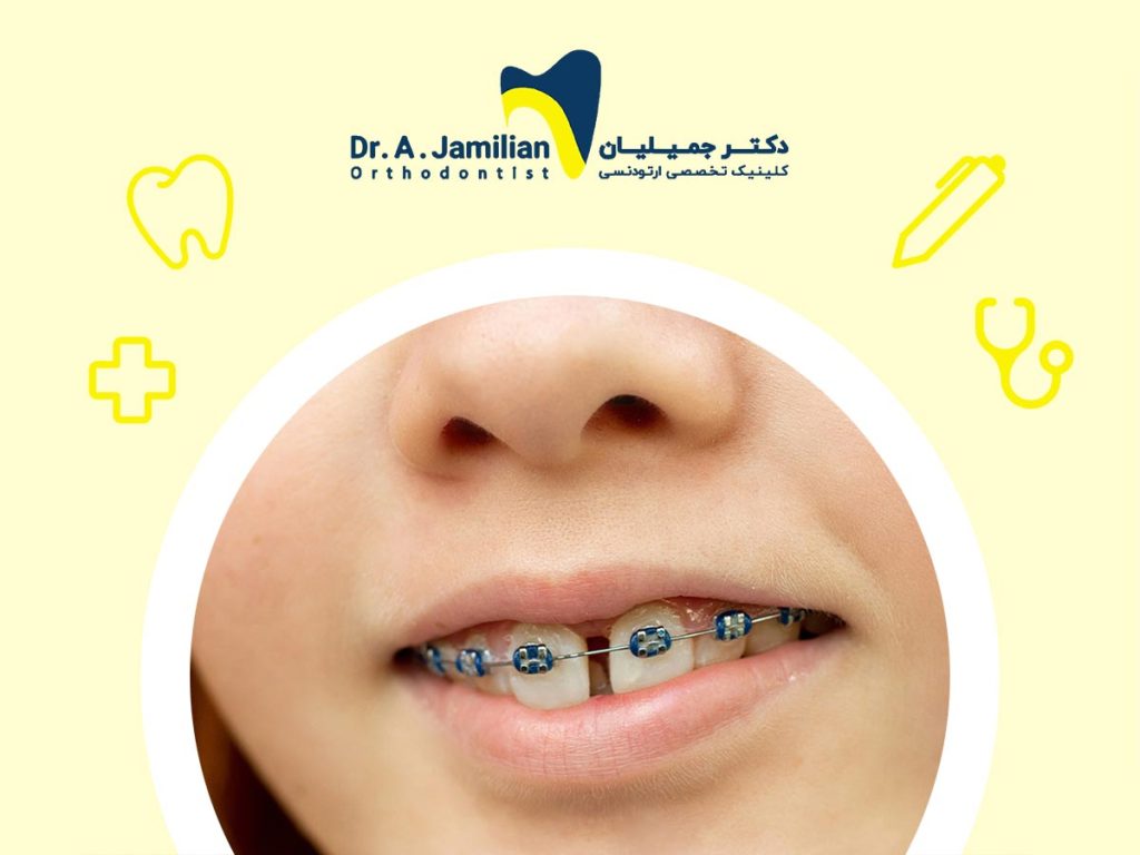 What is frenum and frenectomy? - Dr Jamilian