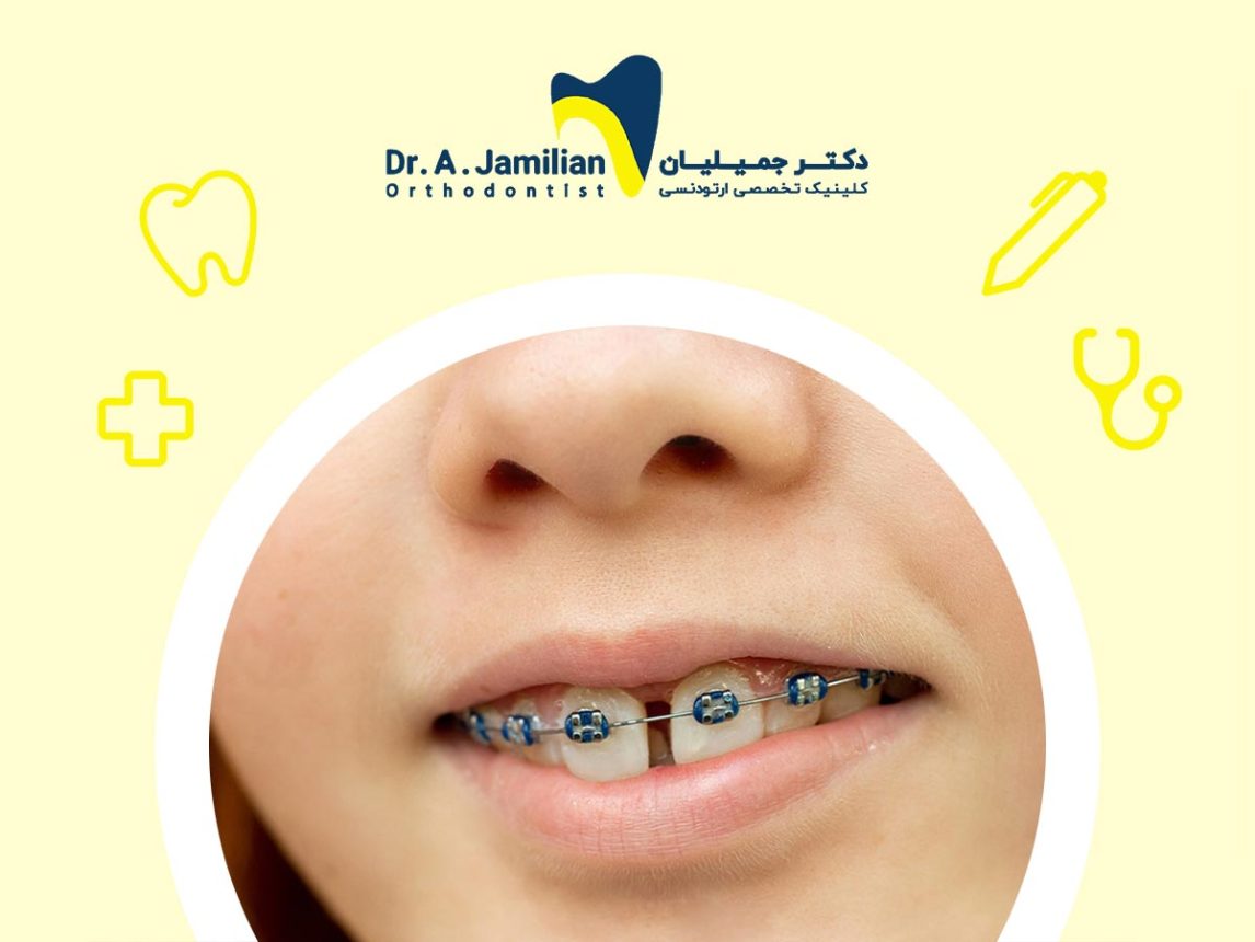 What is frenum and frenectomy? - Dr Jamilian