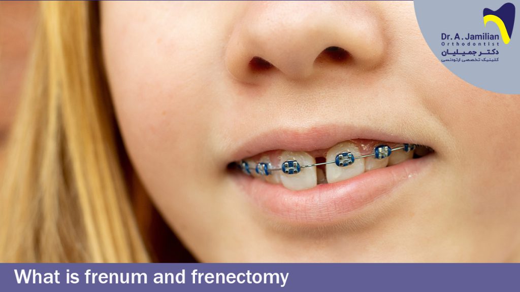 What is frenum and frenectomy? - Dr Jamilian