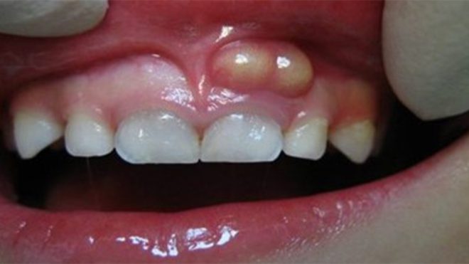 Tooth Abscess - Dr Jamilian