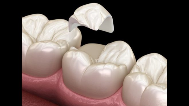 What Are Dental Inlays And Onlays? - Dr Jamilian