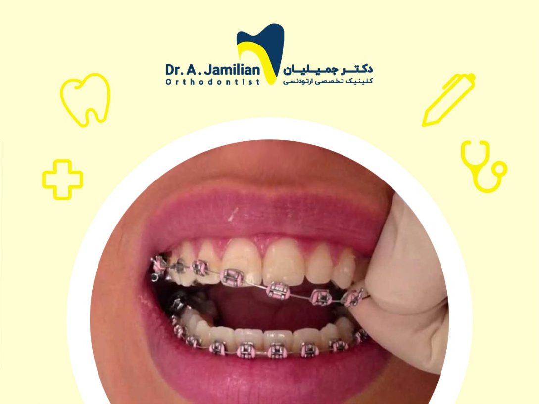 How To Remove Orthodontic Brackets? - Dr Jamilian