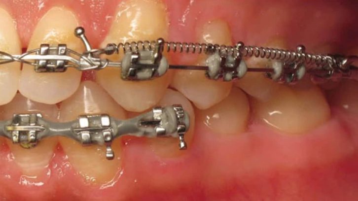 Orthodontic Instruments and Devices - Dr Jamilian