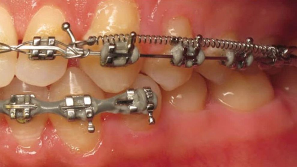 Orthodontic Instruments and Devices - Dr Jamilian