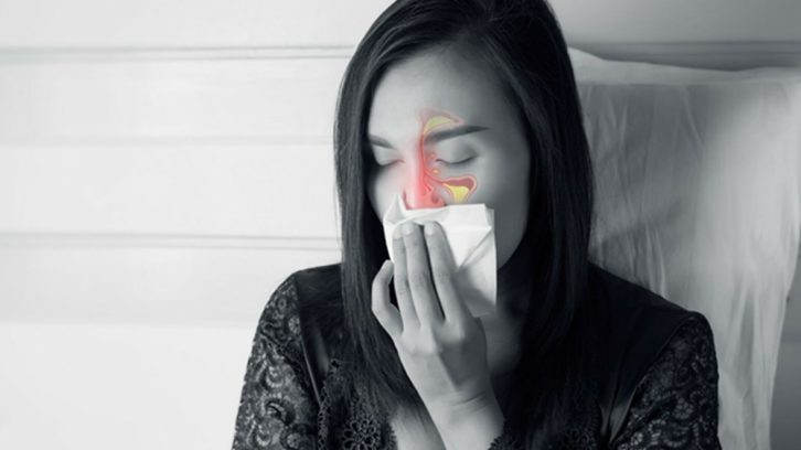 Sinus Opening Due To Tooth Extraction - Dr Jamilian