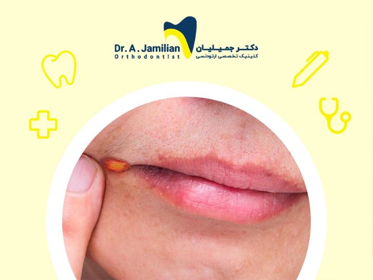 Angular Cheilitis Causes and Treatments - Dr Jamilian