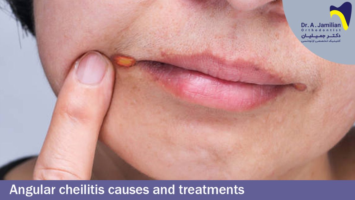 Angular Cheilitis Causes and Treatments - Dr Jamilian