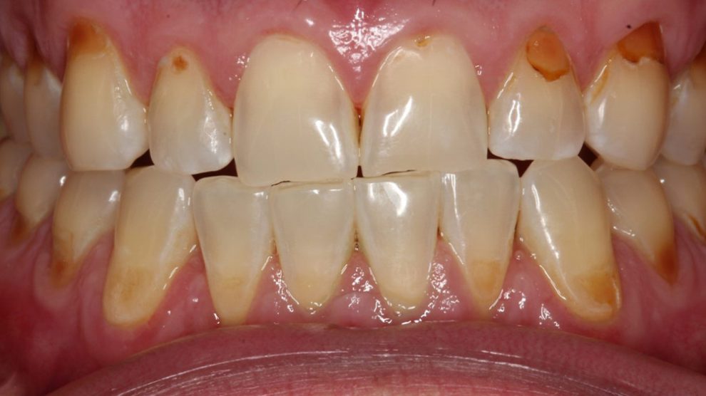 Everything you need to know about the enamel - Dr Jamilian